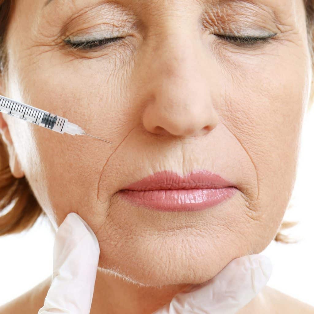 Injections acide hyaluronique sillon nasogénien et plis d'ameturme ...